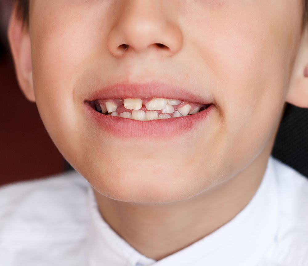 Ortodoncia Infantil: La Mejor Edad Para Empezar - City Dental
