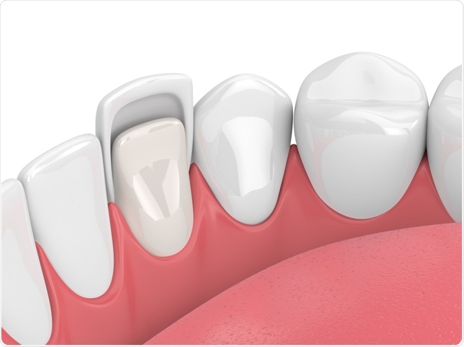 ¿Cuánto Tiempo Duran Las Carillas Dentales? - City Dental ¿Cuánto Tiempo Duran Las Carillas Dentales? - City Dental